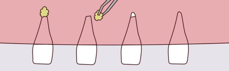 Apicoectomy from Your Endodontist in Raleigh | HH Hancock